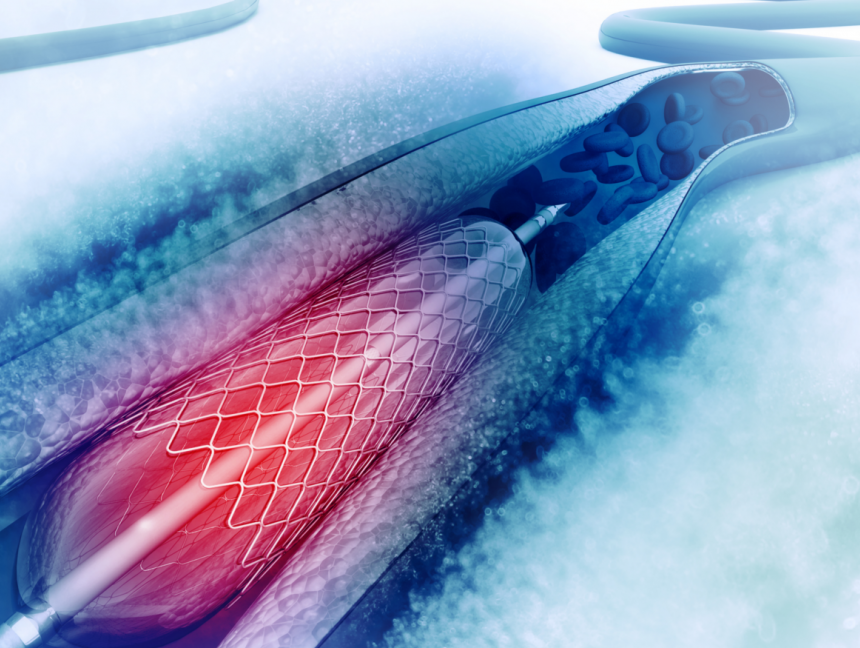 Coronary Angiography/Stenting – North West Hospital Cardiology
